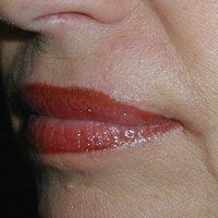 Basal Cell Carcinoma Lip